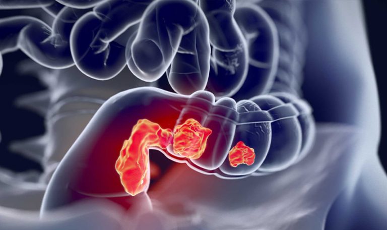 Rektum Kanseri - Doç. Dr. Timuçin EROL